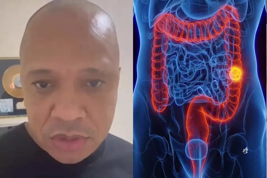 O que é câncer inguinal? Entenda a doença que tirou a vida de Anderson ...